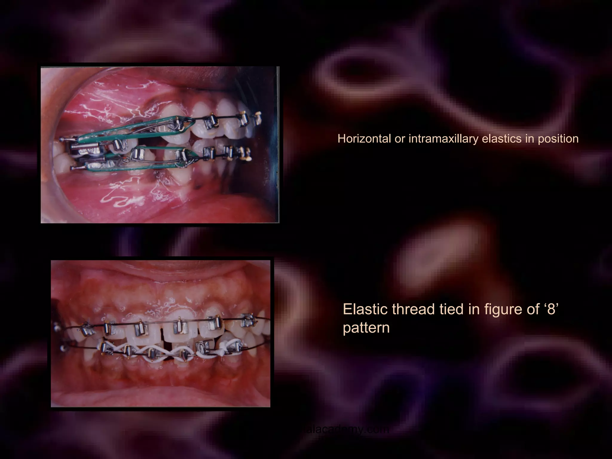 Traditional begg technique stage 1 and stage 2 | PPT