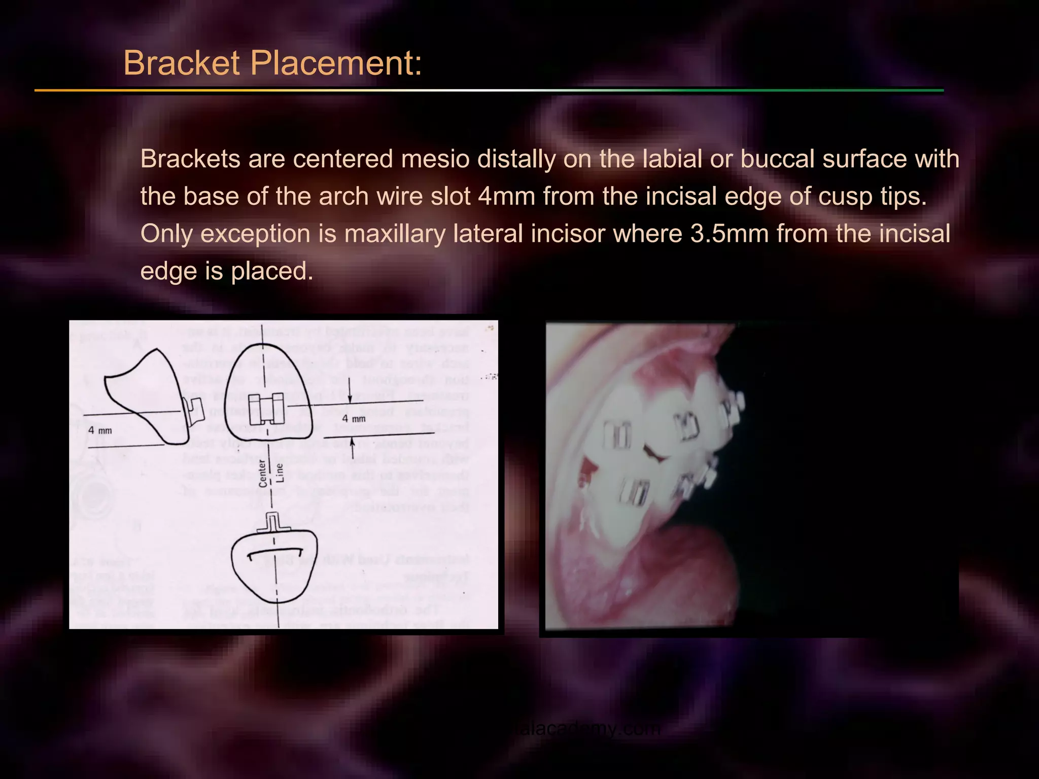Traditional begg technique stage 1 and stage 2 | PPT