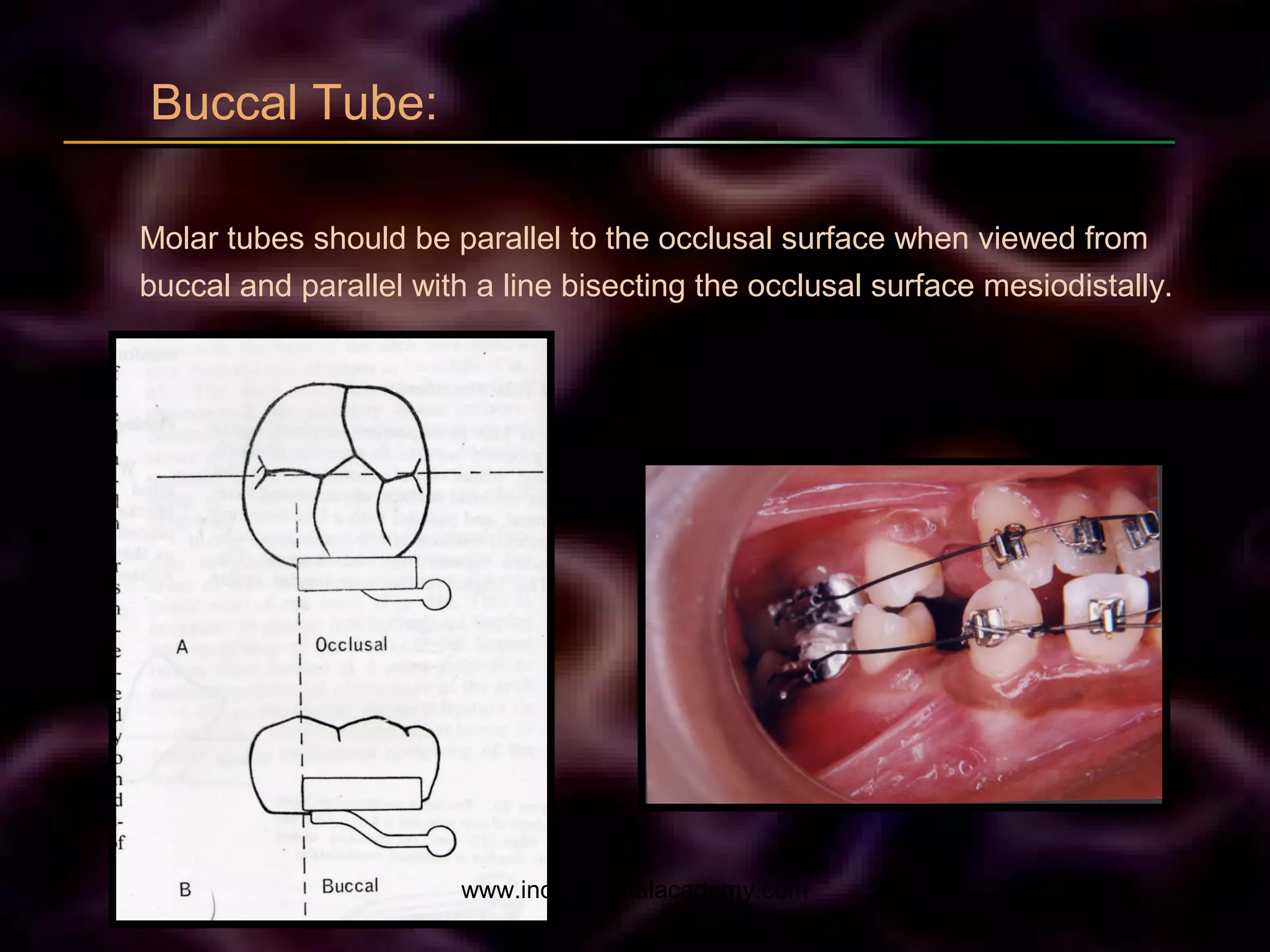 Traditional begg technique stage 1 and stage 2 | PPT