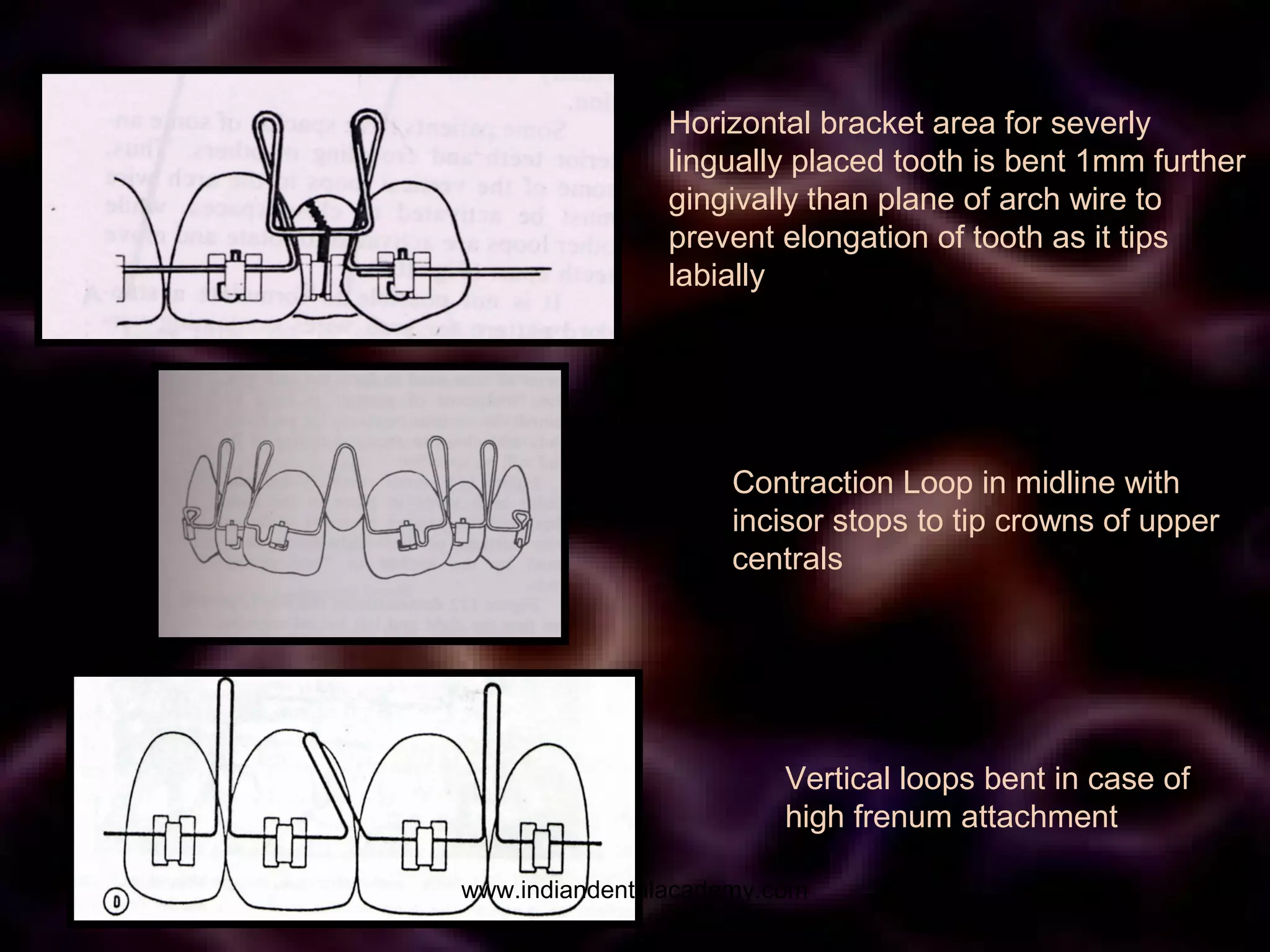 Traditional begg technique stage 1 and stage 2 | PPT