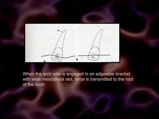 Traditional begg technique stage 1 and stage 2 | PPT | Dental Health ...