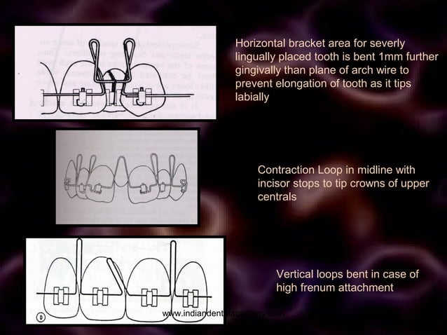 Traditional begg technique stage 1 and stage 2 | PPT | Dental Health ...