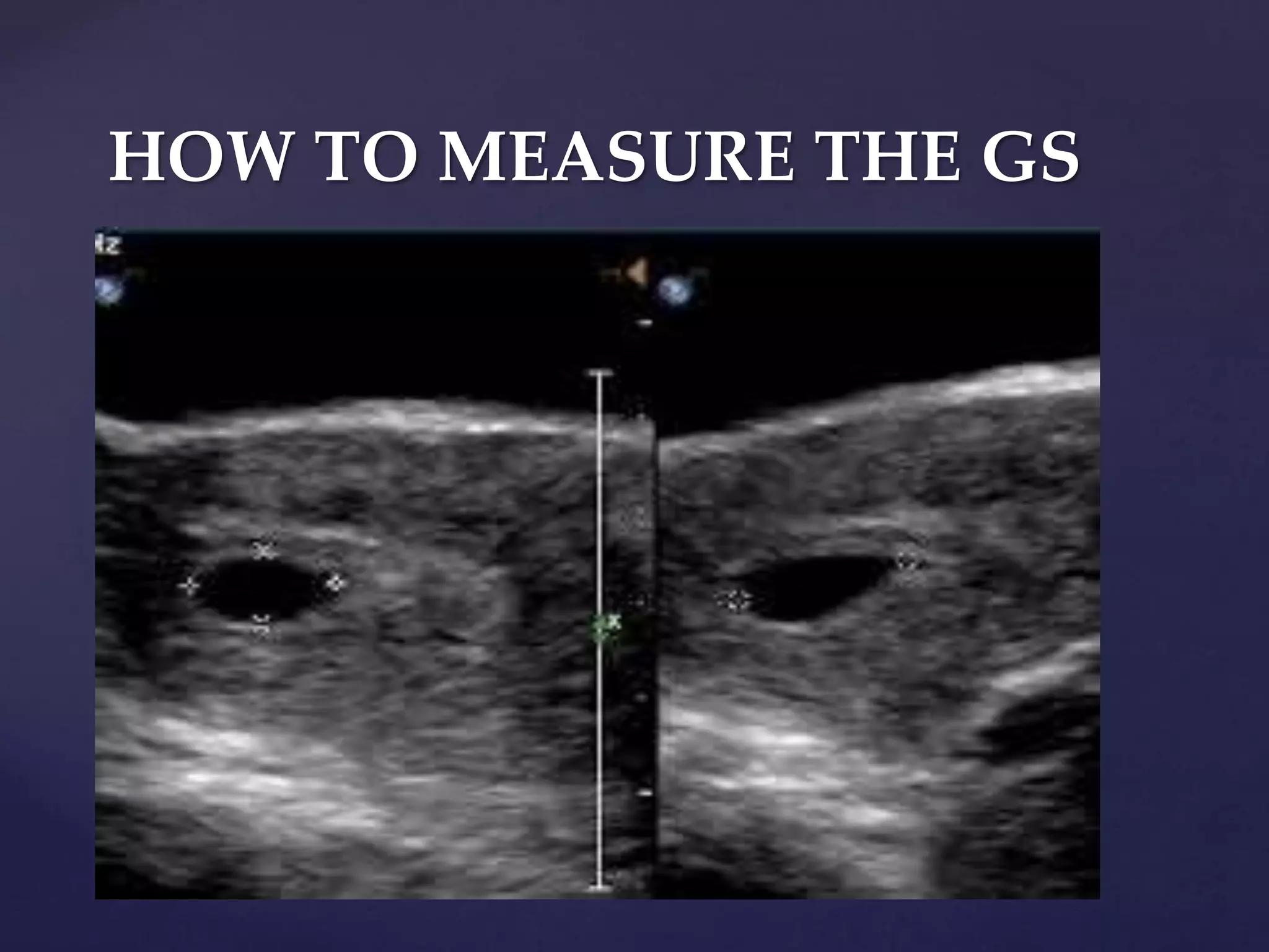 BASIC OBSTETRIC ULTRASOUND TRAINING | PPTX