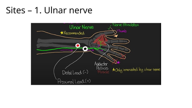 Train Of Four Method Using Peripheral Nerve Stimulator Ppt