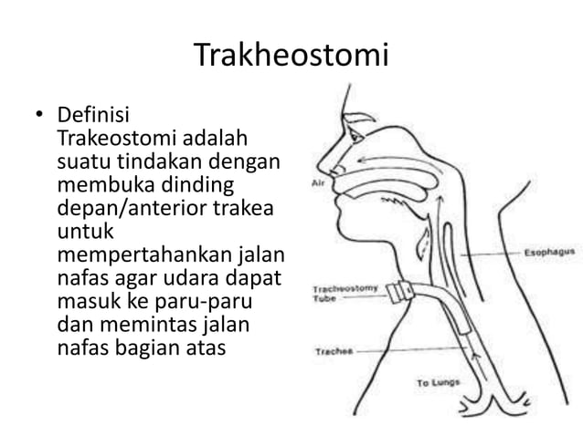 Trakeostomi | PPTX