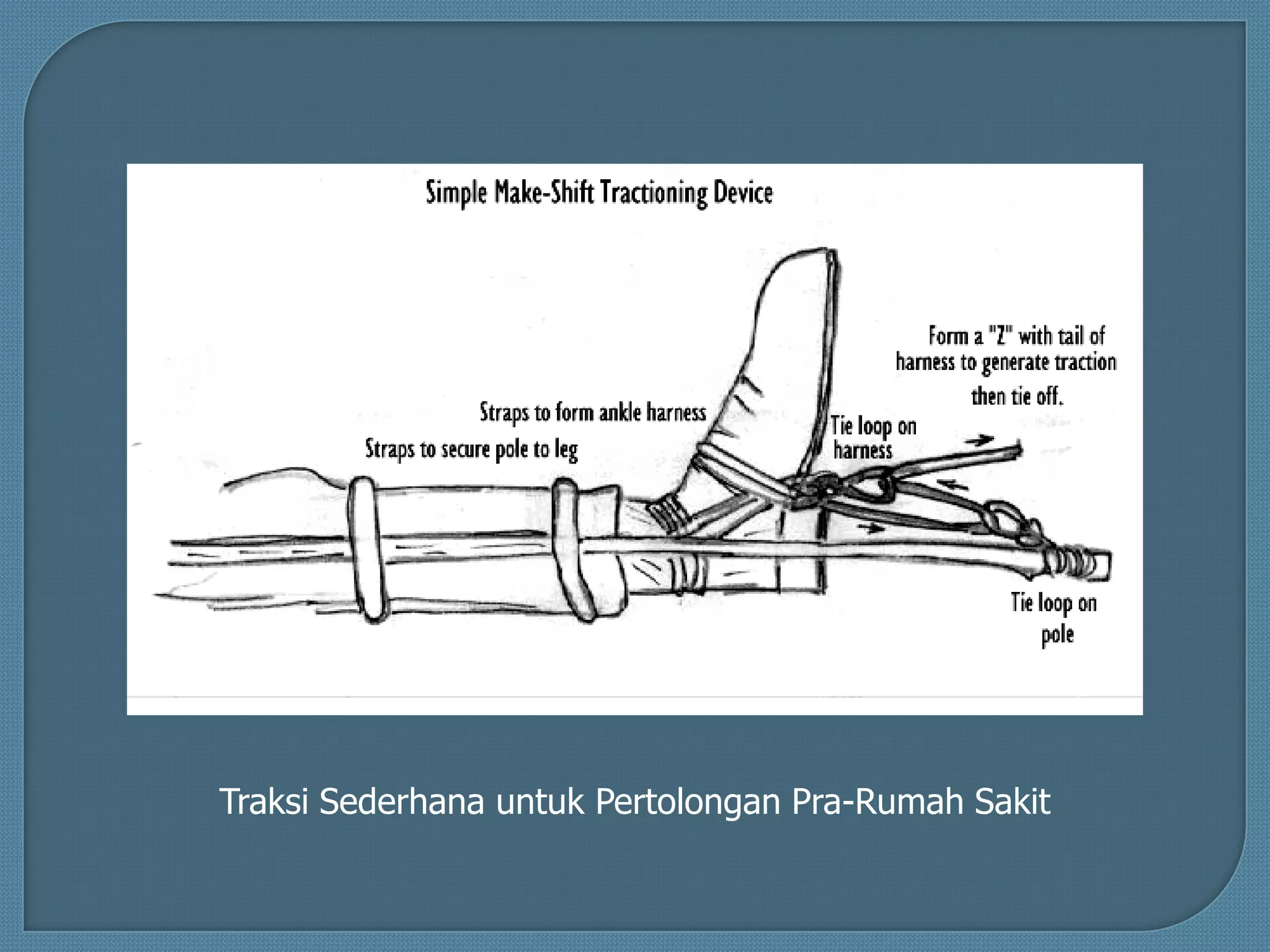 Traksi Dalam Orthopaedi Dr Yuda Umm | PPTX