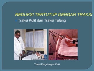 Traksi Dalam Orthopaedi Dr Yuda Umm | PPTX