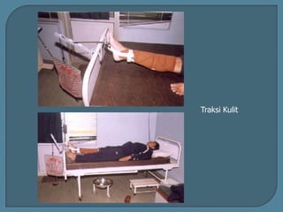 Traksi Dalam Orthopaedi Dr Yuda Umm | PPTX