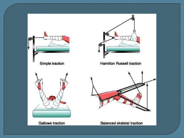 Traksi Dalam Orthopaedi Dr Yuda Umm | PPTX