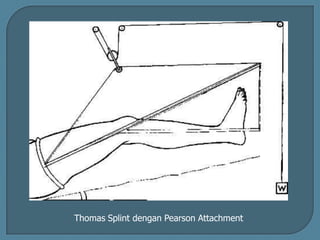 Traksi Dalam Orthopaedi Dr Yuda Umm | PPTX