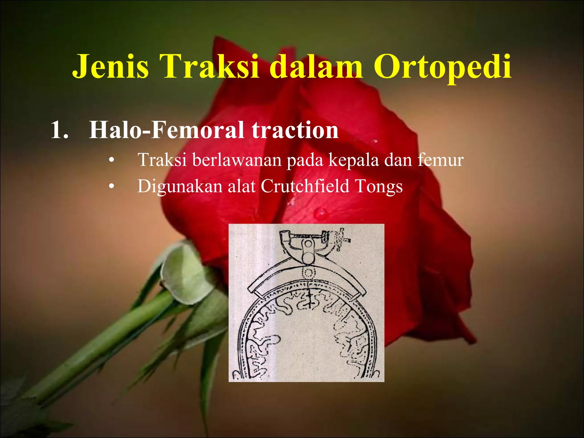 Traksi dalam ortopedik | PPT