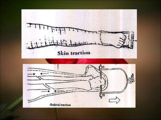 Traksi dalam ortopedik | PPT