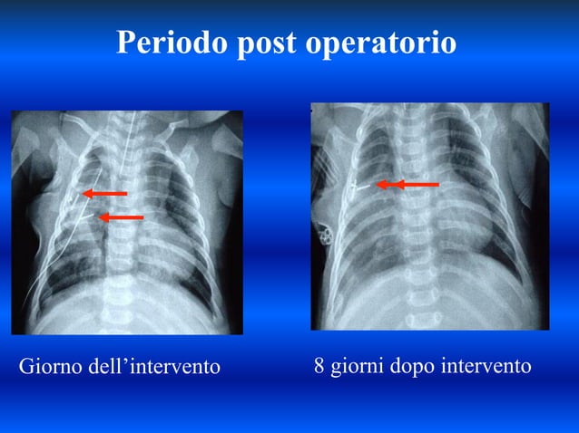 Atresia Esofagea - Chirurgia nel long-gap | PPT