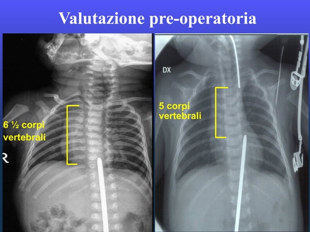 Atresia Esofagea - Chirurgia nel long-gap | PPT