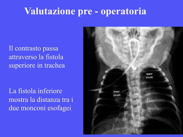 Atresia Esofagea - Chirurgia nel long-gap | PPT