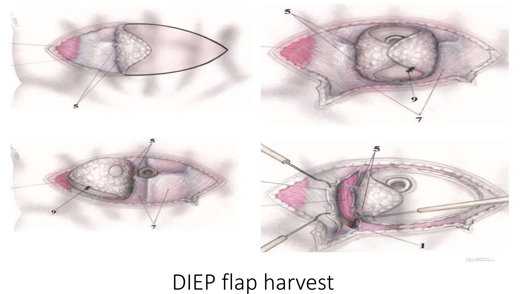 TRAM - Modified TRAM , DIEP Flap - for Breast reconstruction | PPTX