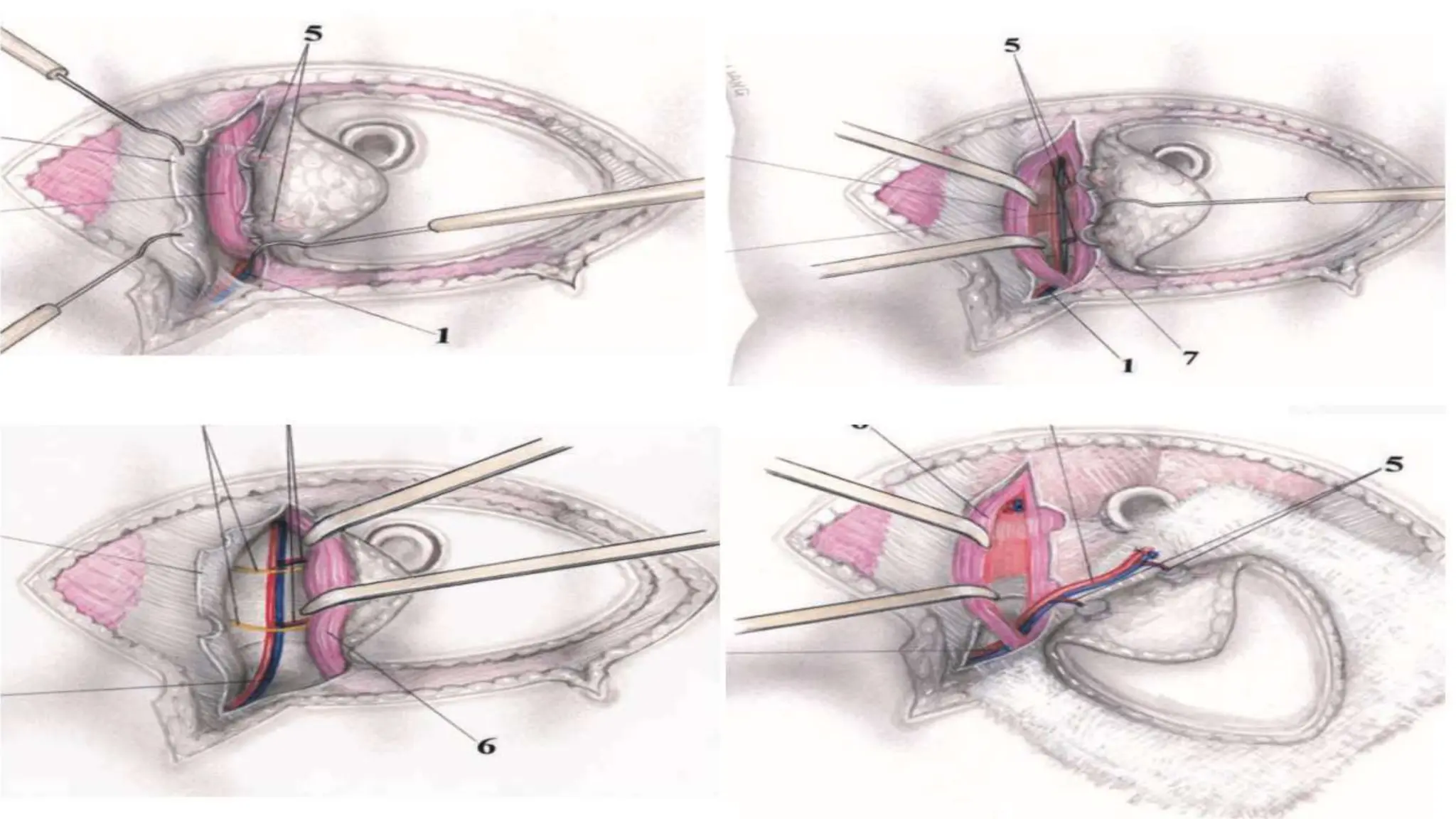 TRAM - Modified TRAM , DIEP Flap - for Breast reconstruction | PPTX