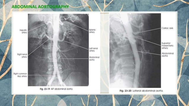 TR angio abdomen, hepatica & renalis.pptx