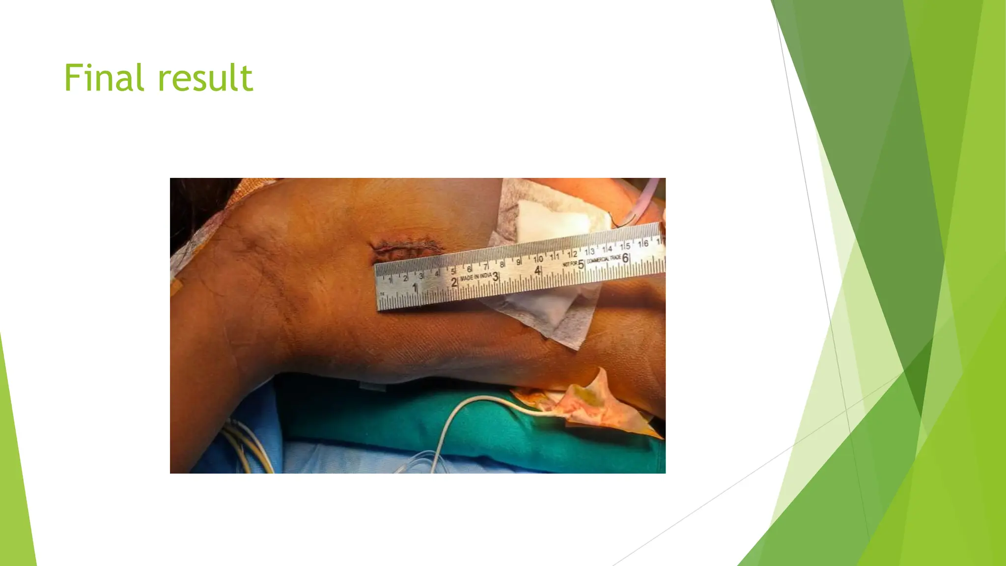 TRANS-AXILLARY APPROACH OF ASD CLOSURE.pptx