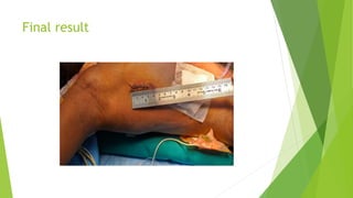 TRANS-AXILLARY APPROACH OF ASD CLOSURE.pptx | Heart and Cardiovascular ...