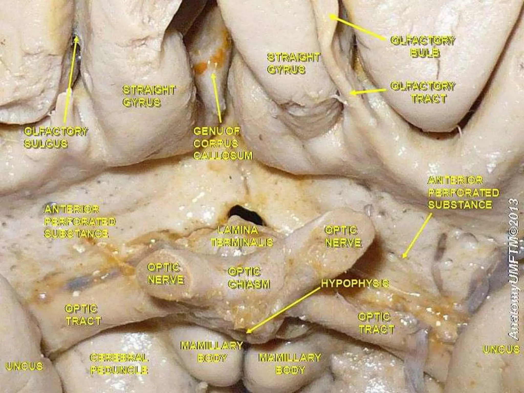 Frontobasal i̇nterhemispheric approach for large suprasellar ...