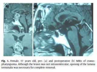 Frontobasal i̇nterhemispheric approach for large suprasellar ...