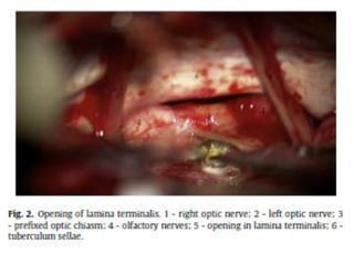 Frontobasal i̇nterhemispheric approach for large suprasellar ...