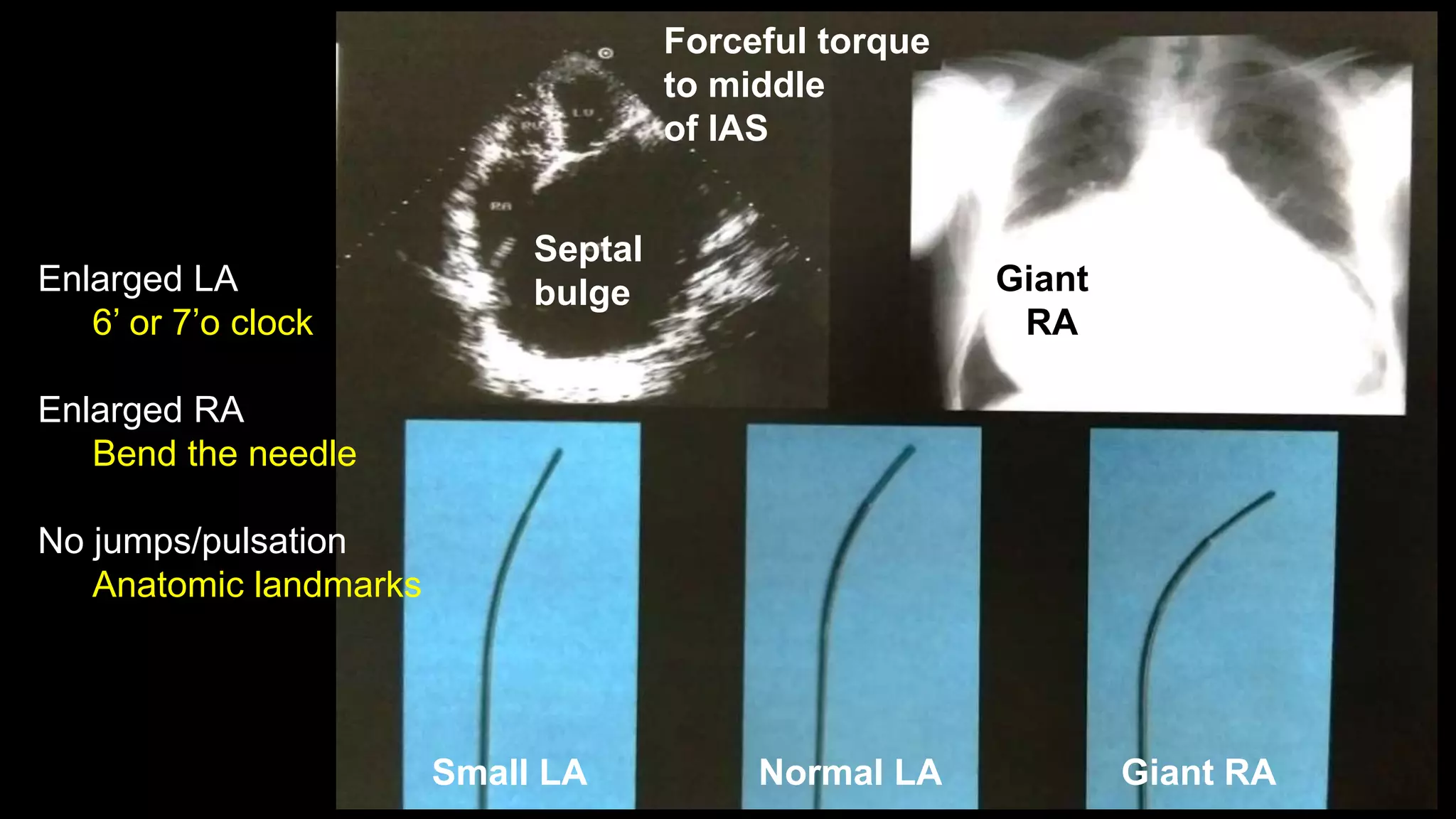 Trans septal puncture | PPTX