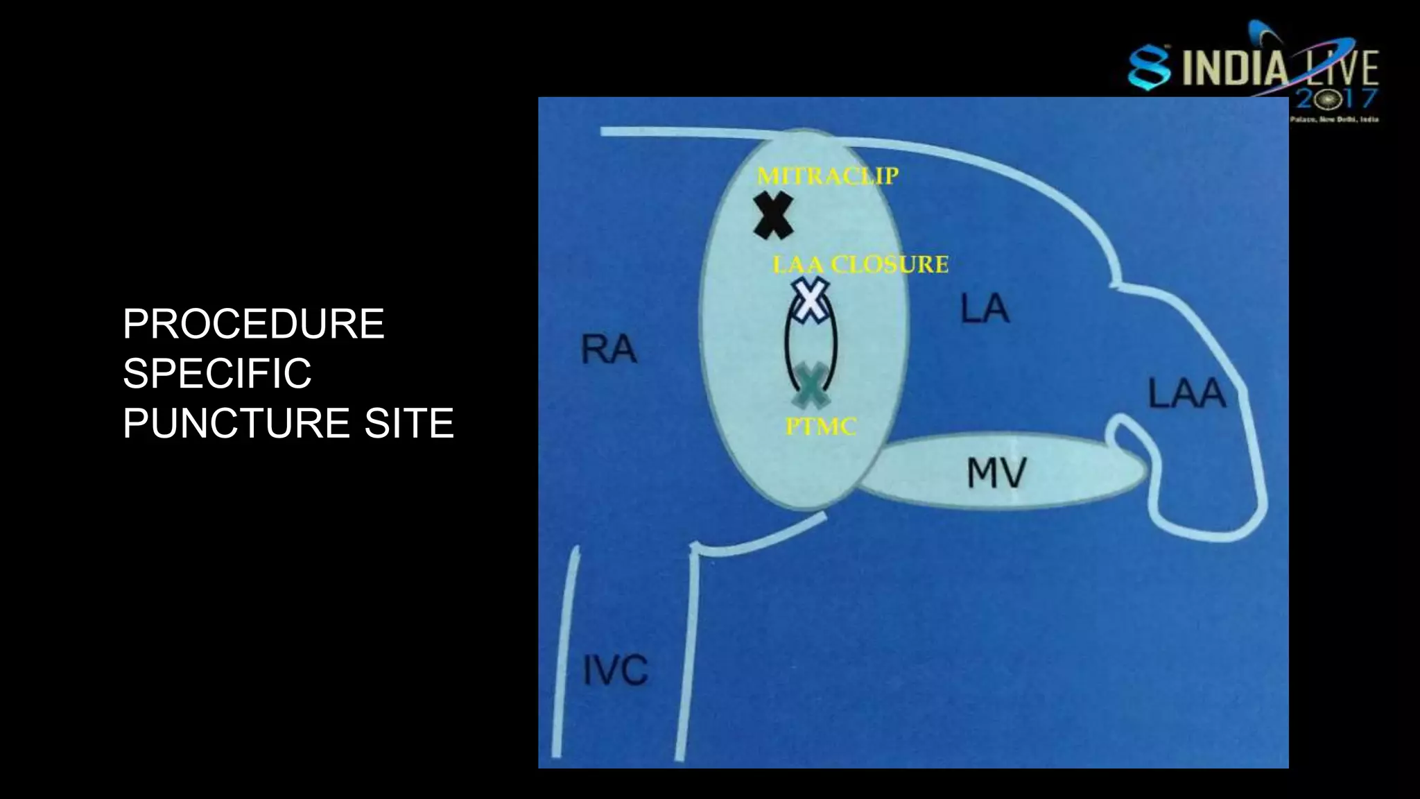 Trans septal puncture | PPTX