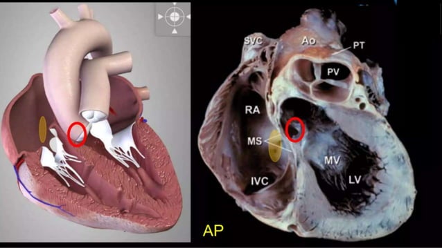TRANS-SEPTAL PUNCTURE in Interventional Cardiology | PPTX | Heart and ...