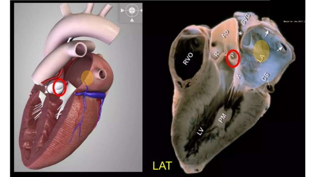 TRANS-SEPTAL PUNCTURE in Interventional Cardiology | PPTX | Heart and ...