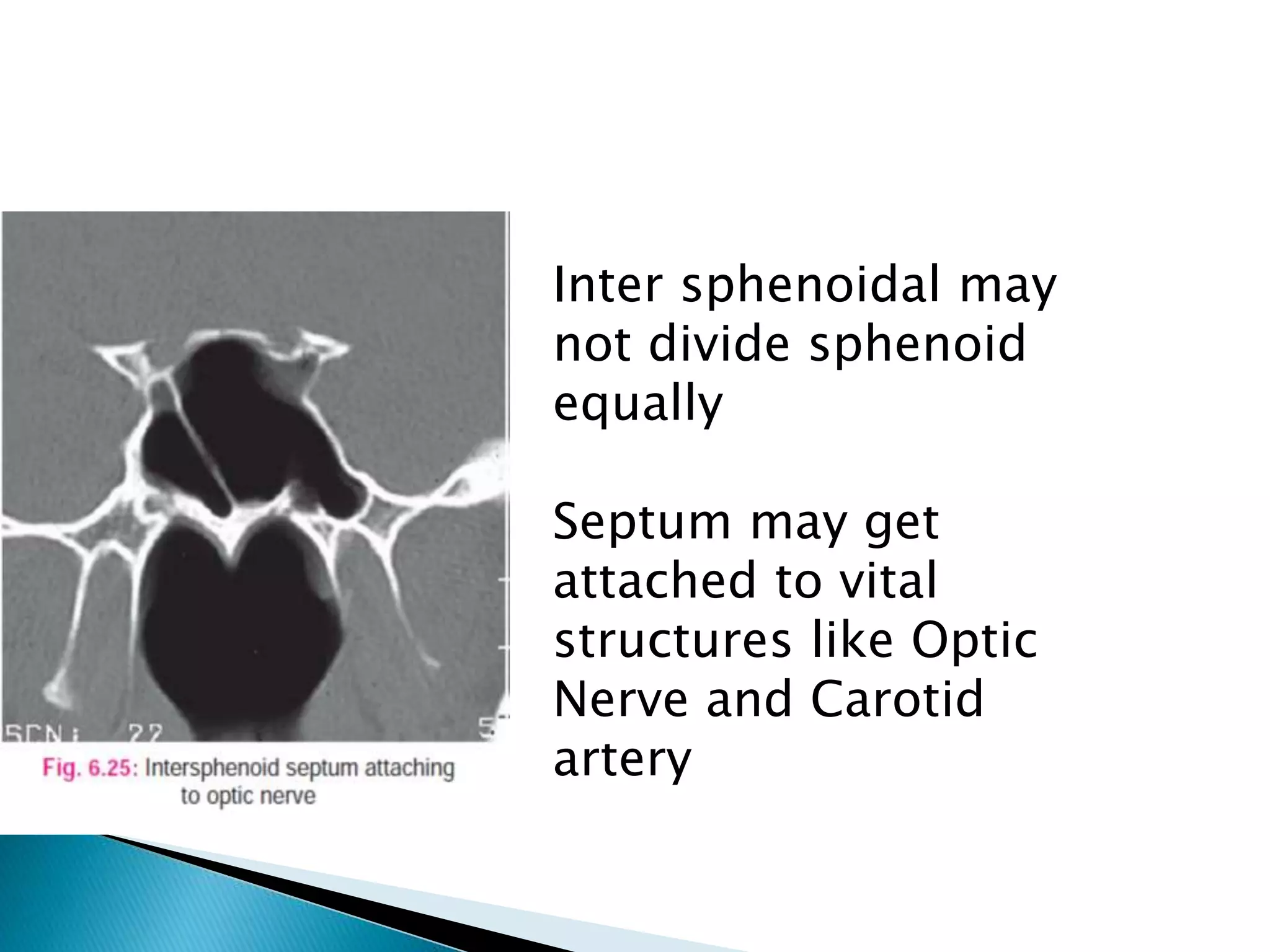 Trans sphenoid hypophysectomy | PPTX