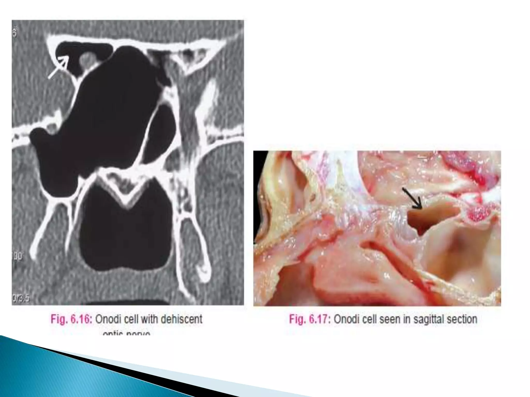 Trans sphenoid hypophysectomy | PPTX