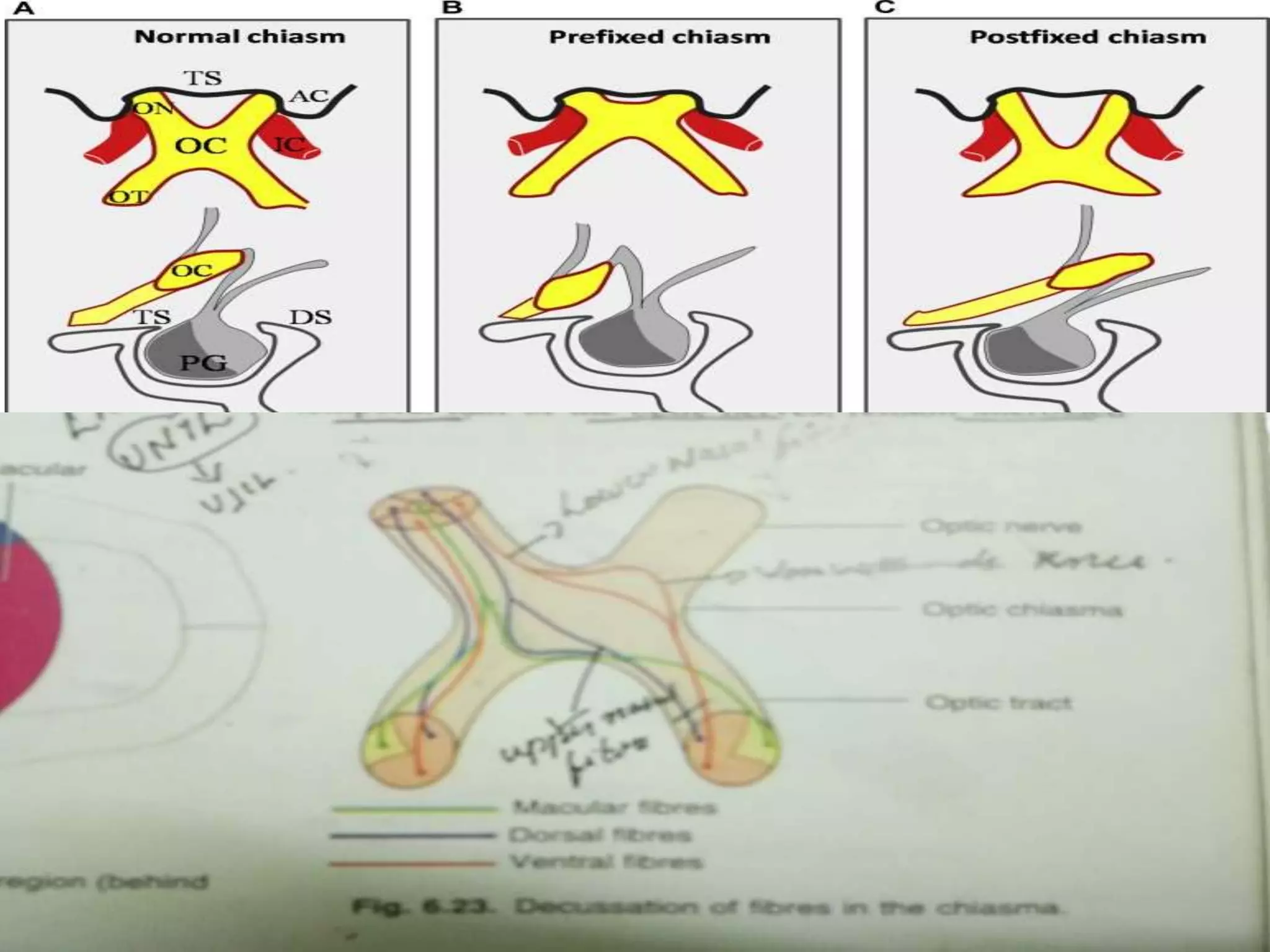 Trans sphenoid hypophysectomy | PPTX