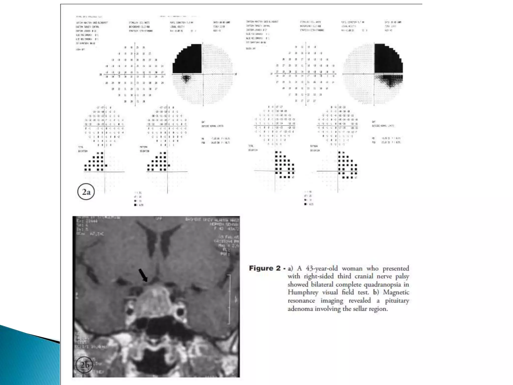Trans sphenoid hypophysectomy | PPTX