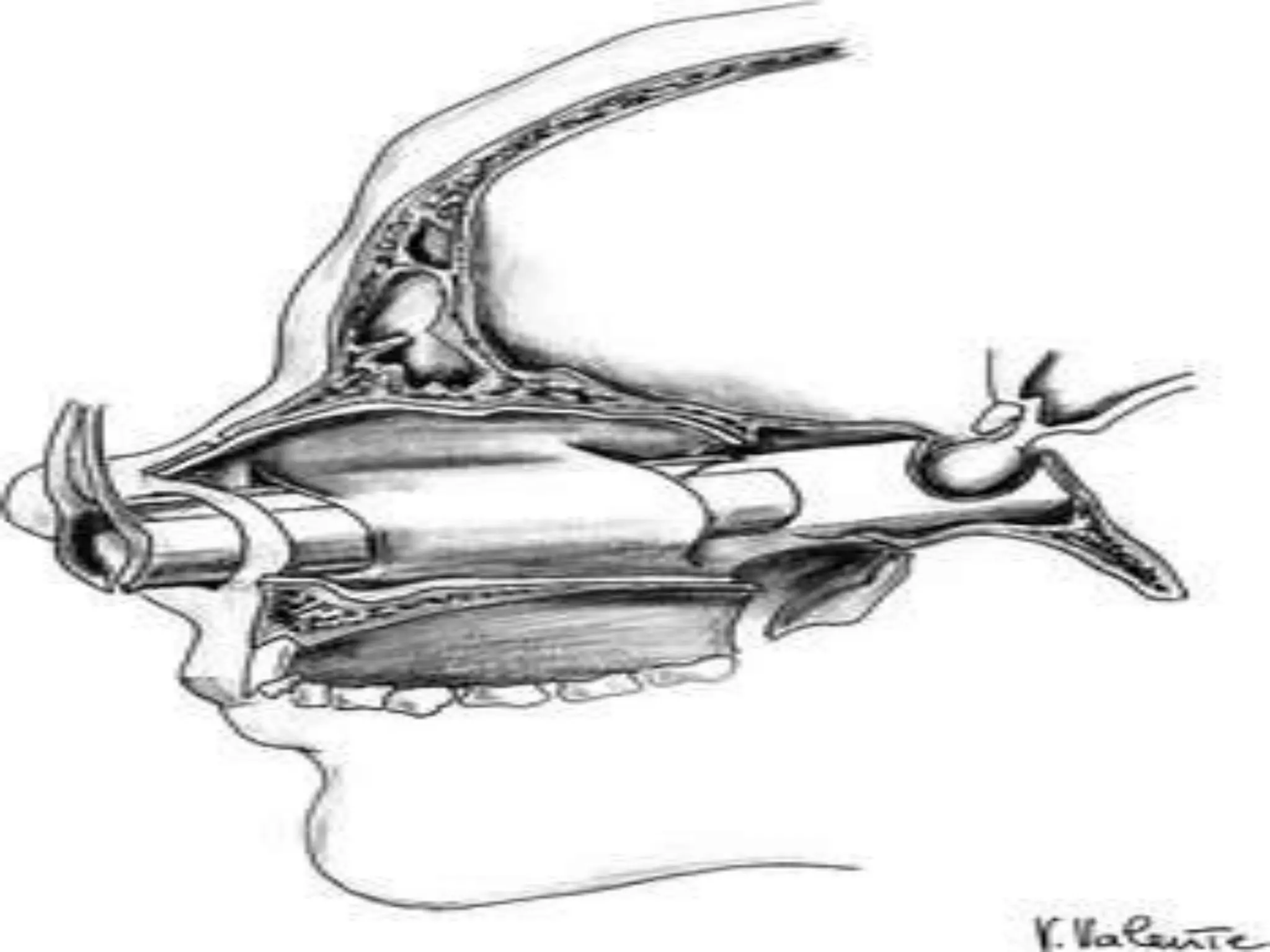 Trans sphenoid hypophysectomy | PPTX