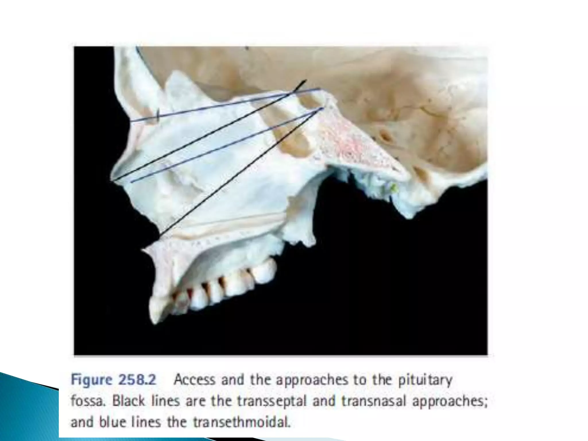 Trans sphenoid hypophysectomy | PPTX