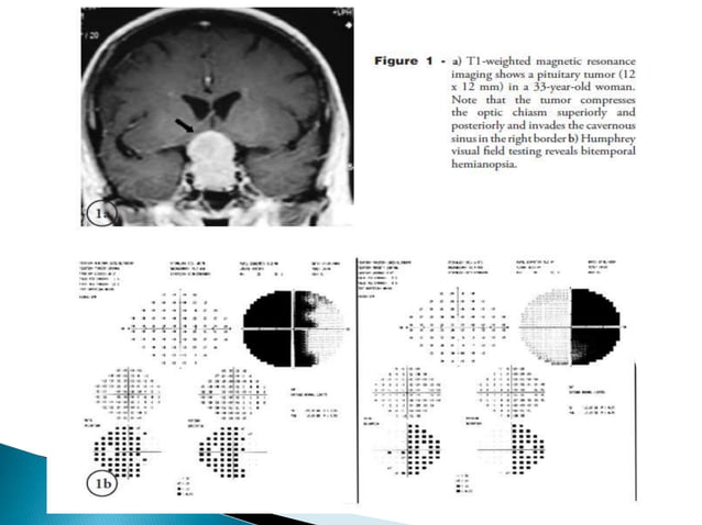 Trans sphenoid hypophysectomy | PPTX
