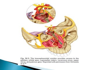 Trans sphenoid hypophysectomy | PPTX