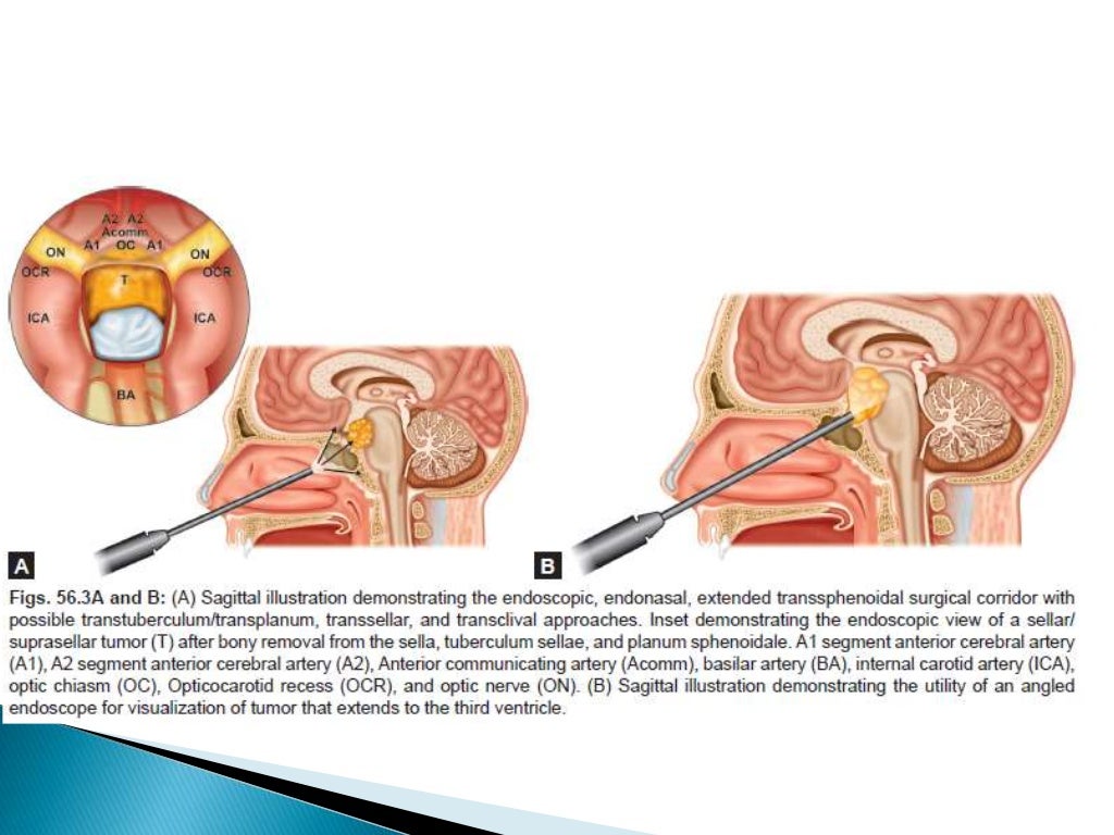 Trans sphenoid hypophysectomy