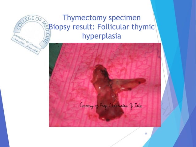 Trans-Sternal Radical Thymectomy for Myaesthenia Gravis.pdf | Thyroid ...
