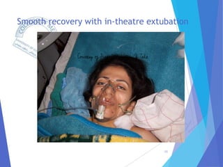 Trans-Sternal Radical Thymectomy for Myaesthenia Gravis.pdf