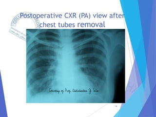 Trans-Sternal Radical Thymectomy for Myaesthenia Gravis.pdf