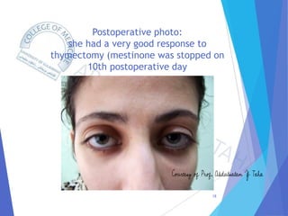 Trans-Sternal Radical Thymectomy for Myaesthenia Gravis.pdf
