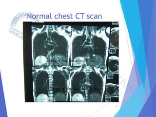 Trans-Sternal Radical Thymectomy for Myaesthenia Gravis.pdf