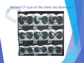 Trans-Sternal Radical Thymectomy for Myaesthenia Gravis.pdf