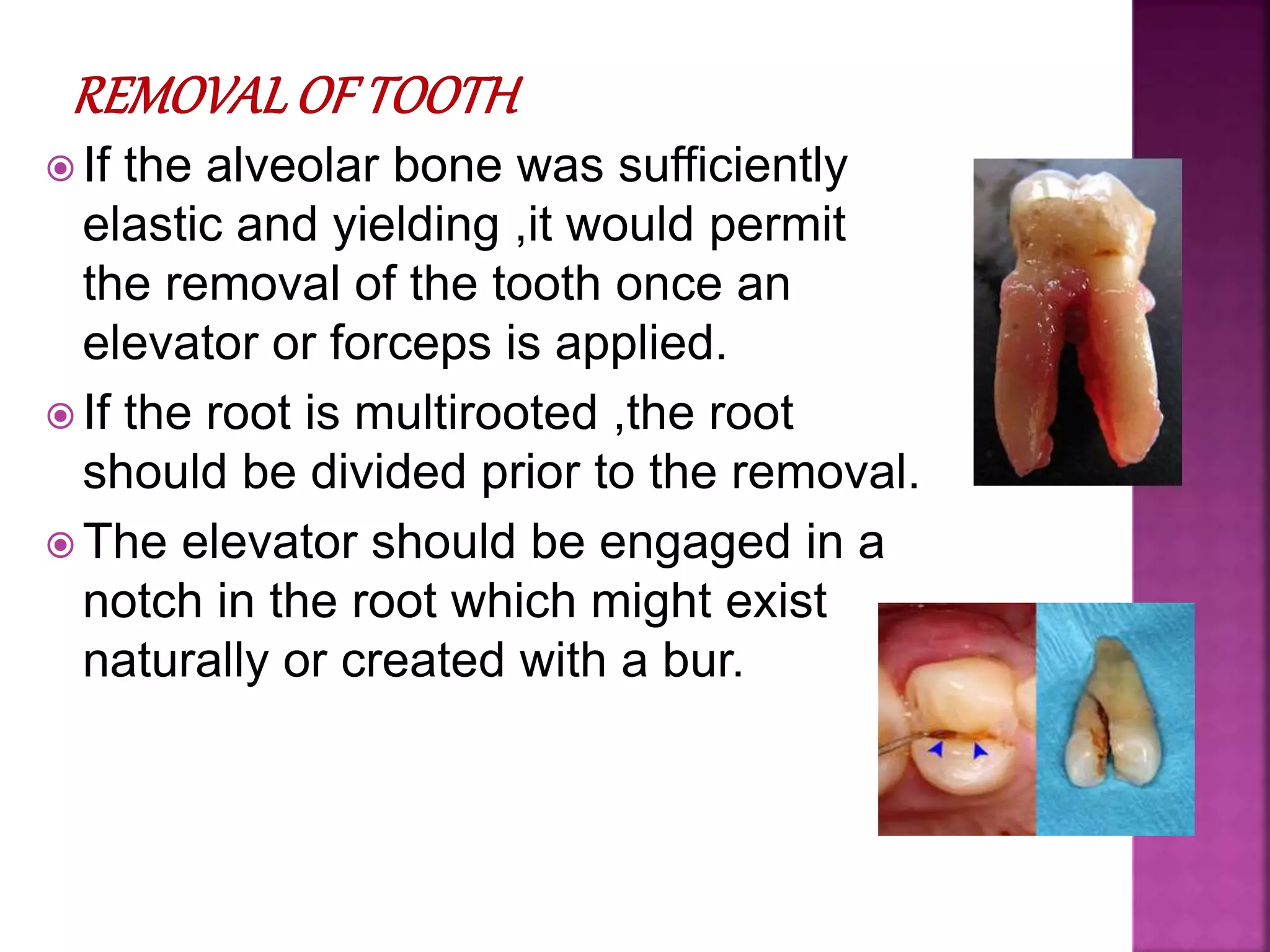 Transalveolar Extraction of tooth | PPTX