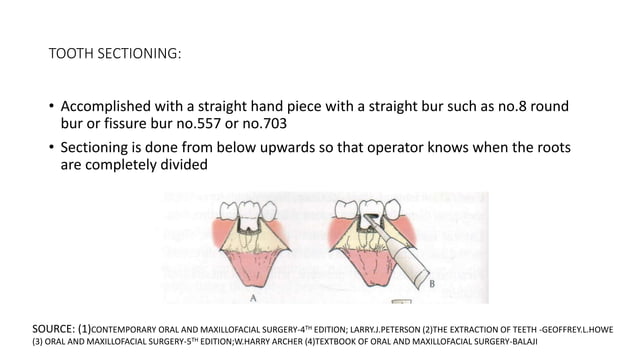 Transalveolar extraction - Dr.harshad nakum (Ahir) | PPTX | Dental ...