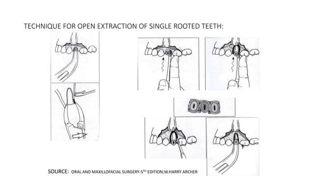 Transalveolar extraction - Dr.harshad nakum (Ahir) | PPTX | Dental ...