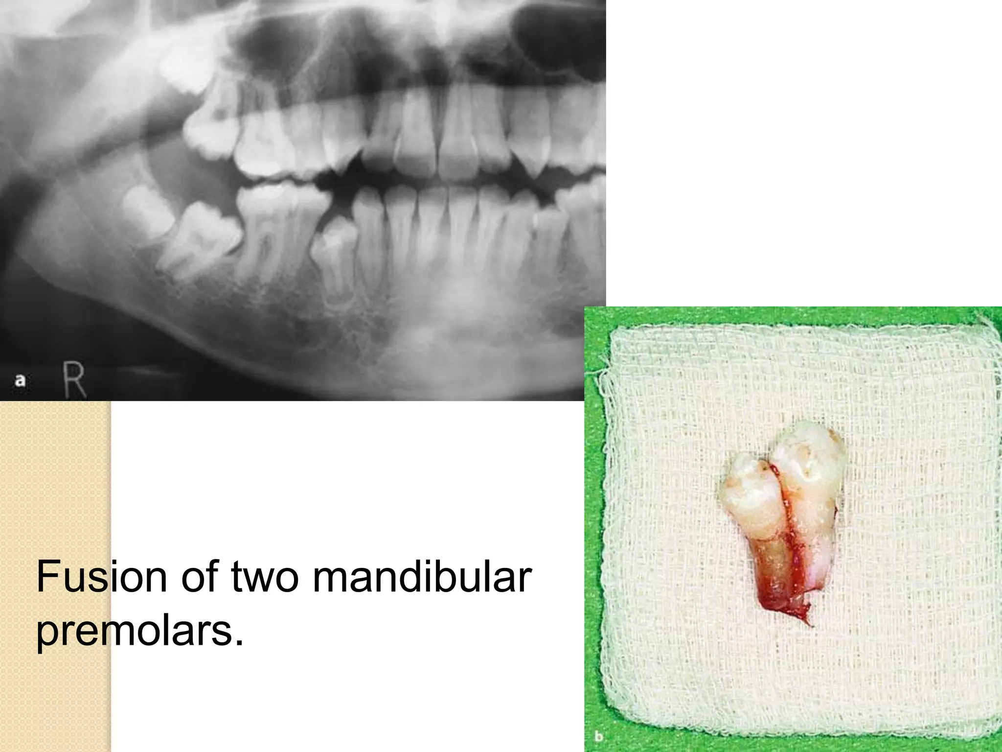 Transalveolar Extraction | PPTX